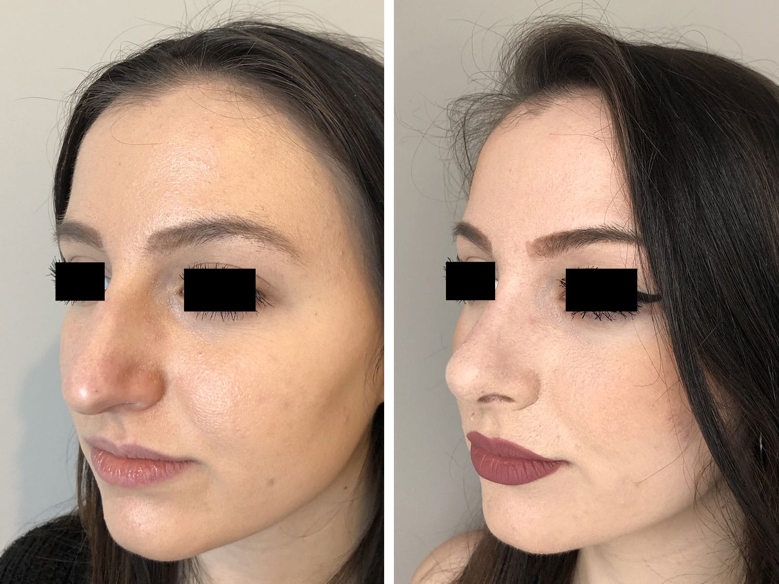 Lividi Da Rinoplastica